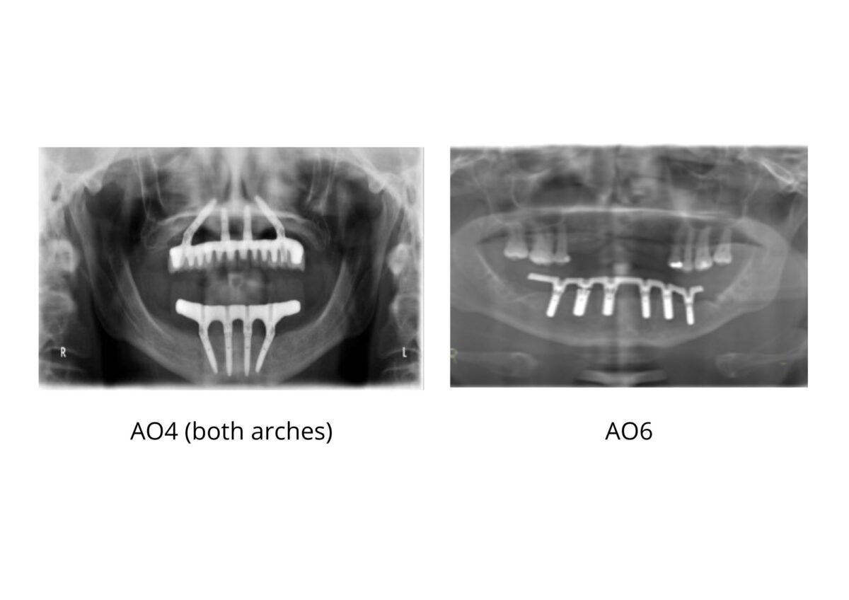 What Are All Teeth on 4 Dental Implants? - All at Once® Implant Bridge