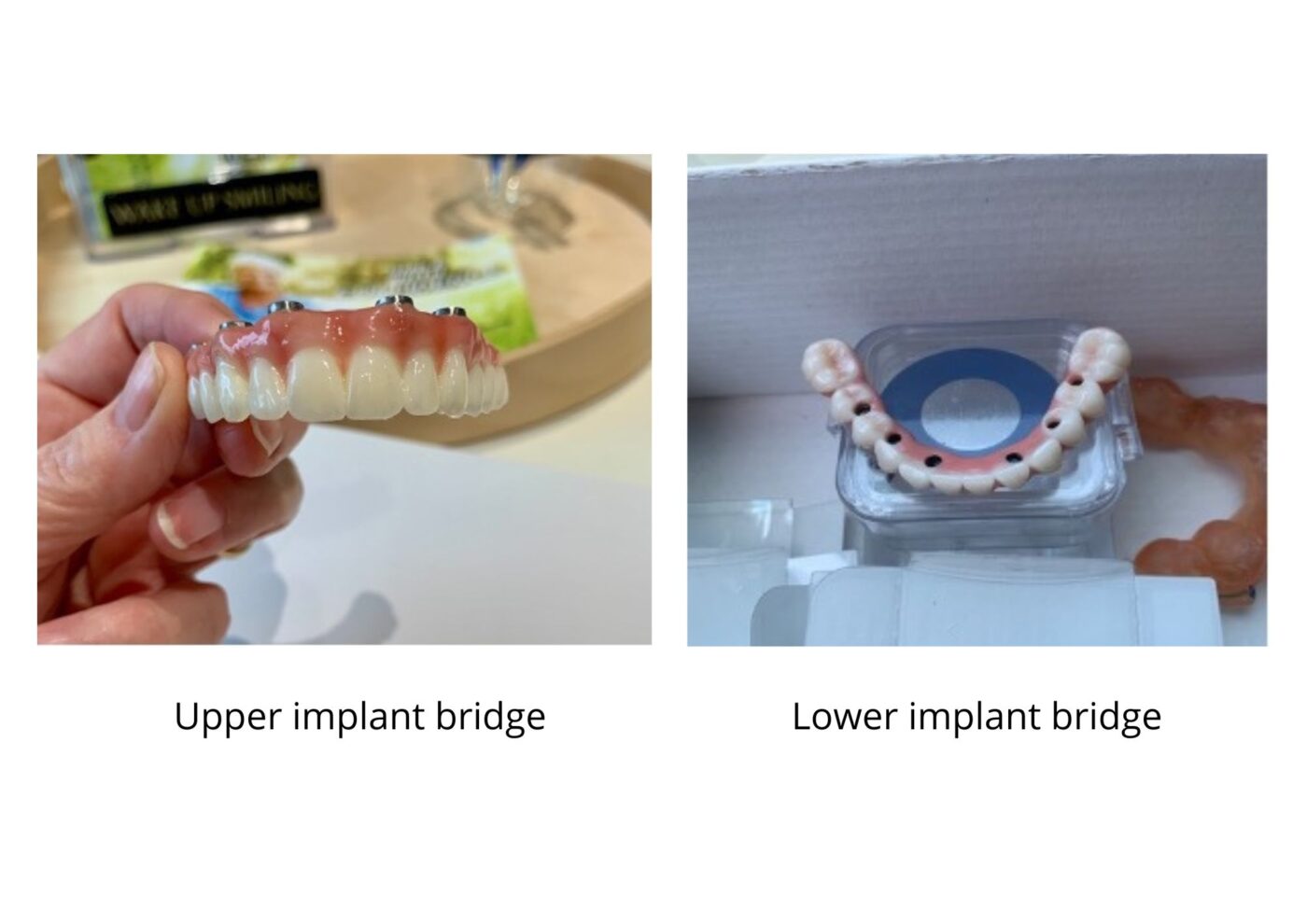 What Are All Teeth on 4 Dental Implants? - All at Once® Implant Bridge