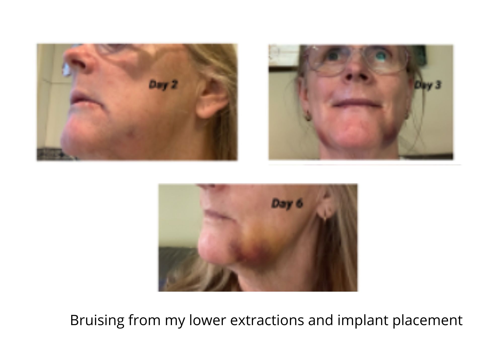 Is Dental Implant Surgery Painful? A Patient’s Perspective on What to ...