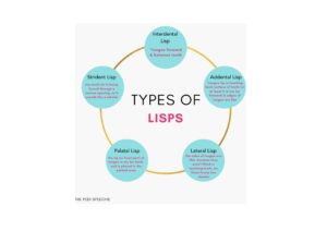 Will Dental Implant Bridges Cause a Lisp? - All at Once® Implant Bridge