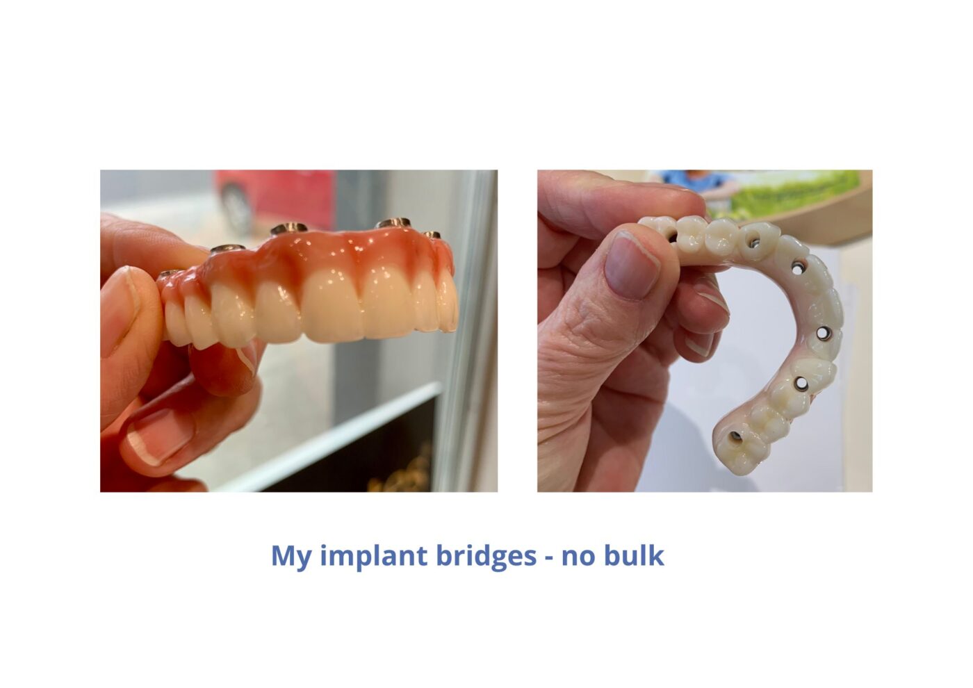 Will Dental Implant Bridges Cause a Lisp? - All at Once® Implant Bridge